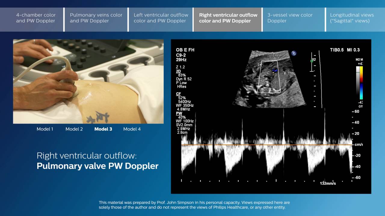 Part 4 - Right ventricular outflow color and PW Doppler - YouTube
