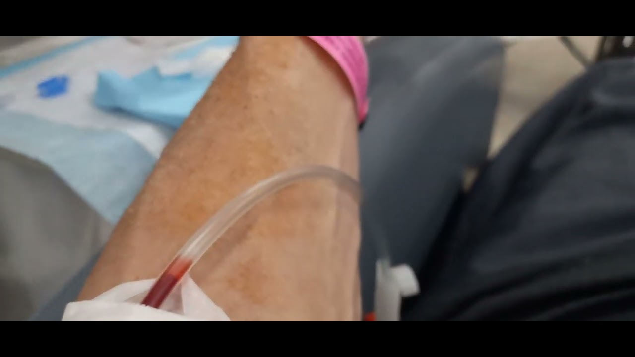 being hooked up to dialysis machine. 2 needles 3 times a week pumping ...