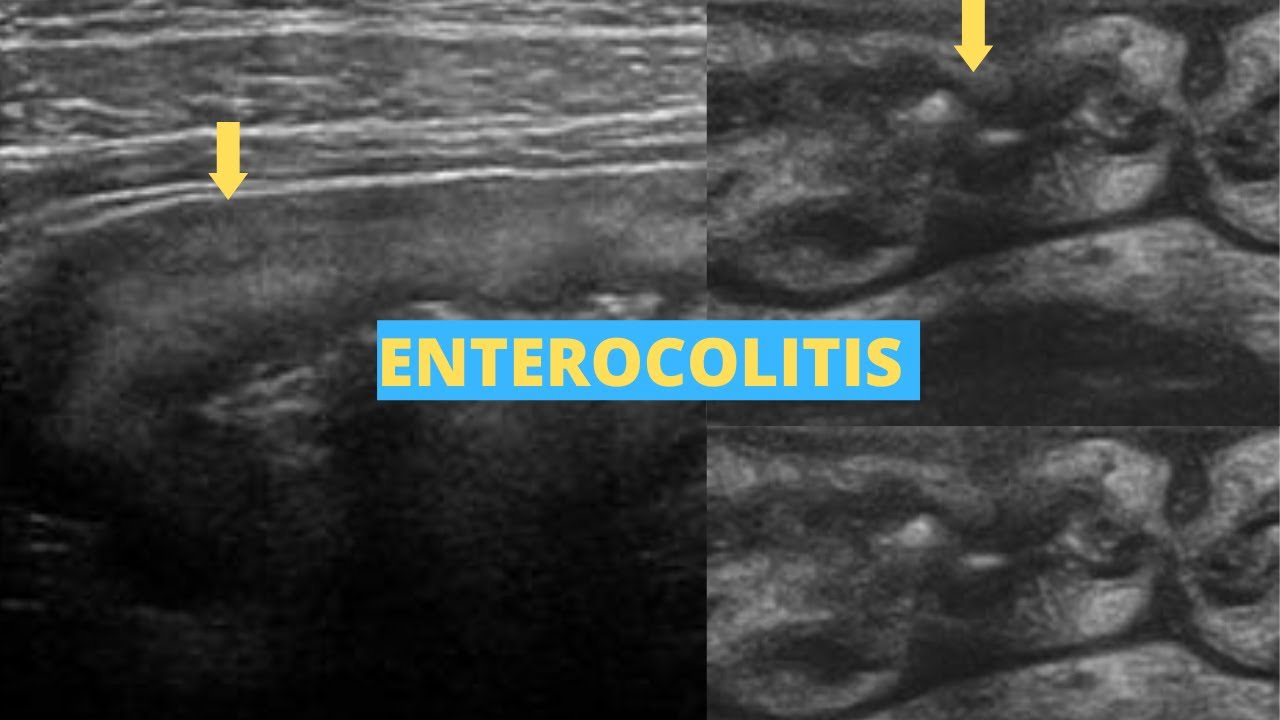 Enterocolitis | Ultrasound Case - YouTube