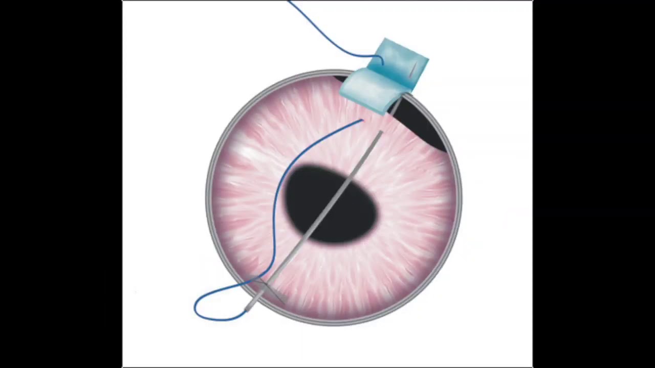 Eye trauma- Iris repair and Cataract surgery with multifocal lens ...