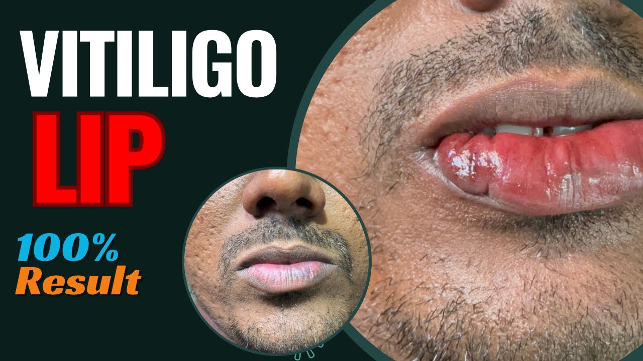 Lip Vitiligo treatment | No side effects | Machu Tattoos | Best Tattoo ...