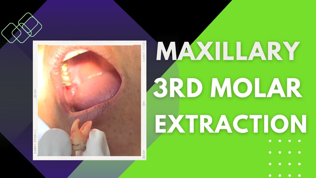 Upper Third Molar | Maxillary Third Molar Extraction #dentistry - YouTube