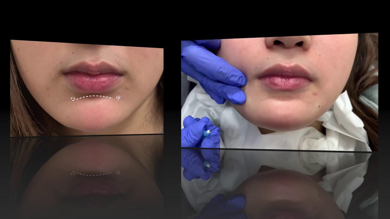 Filler Chin Crease YouTube filler-chin-crease-youtube
