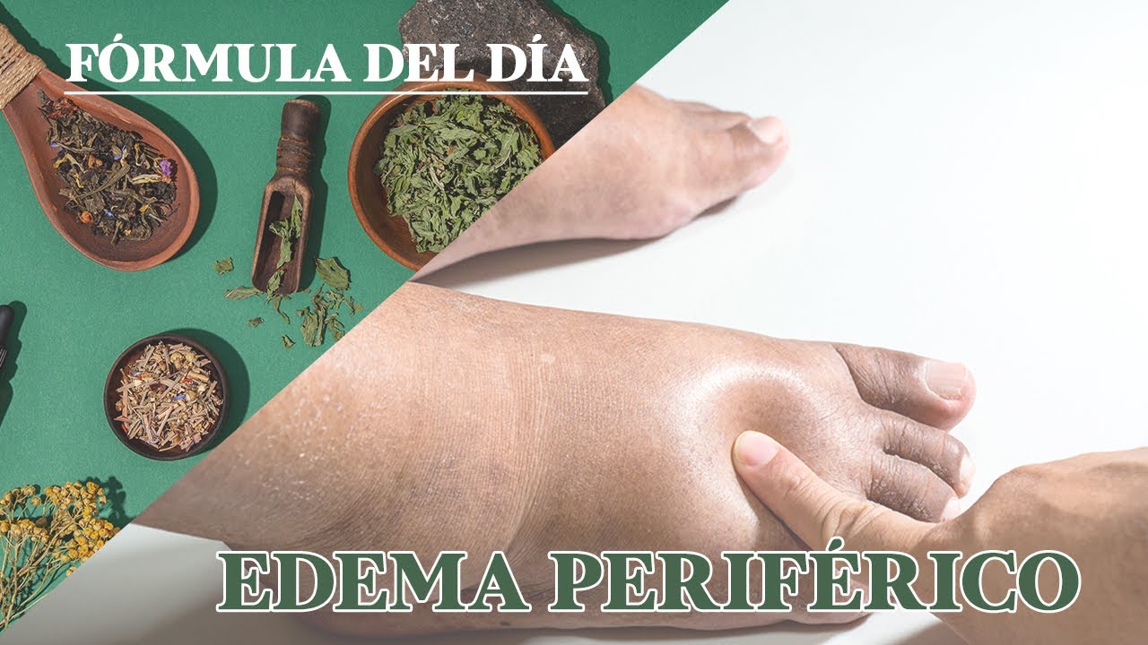 FORMULA HERBOLARIA PARA EDEMA PERIFÉRICO O HINCHAZÓN EN PIES, TOBILLOS ...