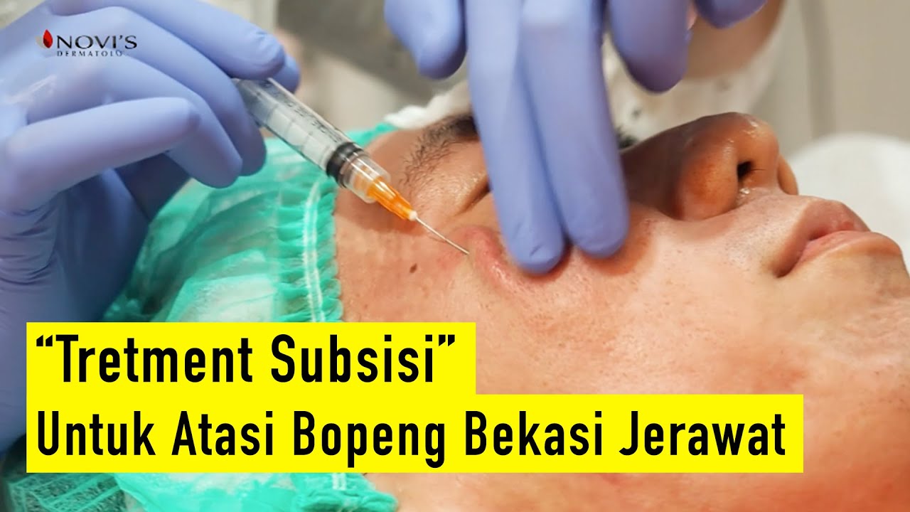 Subsisi - Untuk Atasi Bopeng Bekasi Jerawat - NOVI'S Dermatology Clinic ...