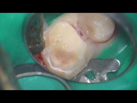 Direct pulp capping and SSC for primary molar with Endocem MTA Premixed ...