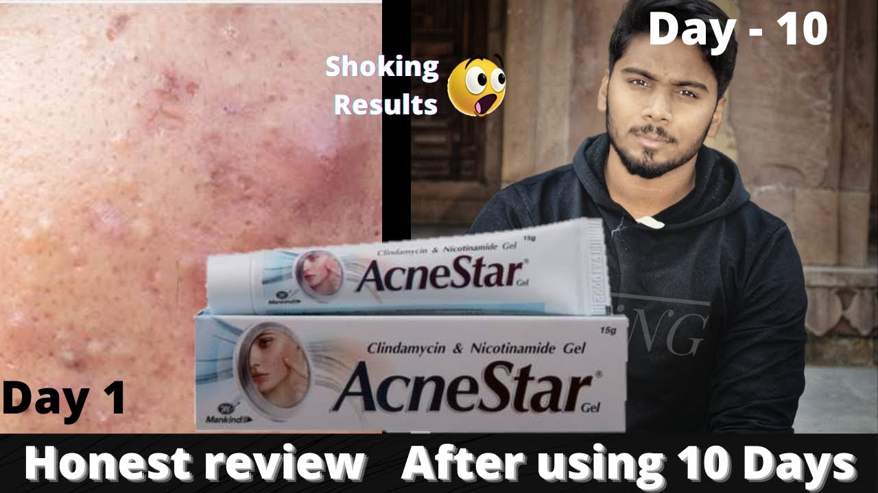 AcneStar Gel Review | Honest Review after using 10 Days | - YouTube