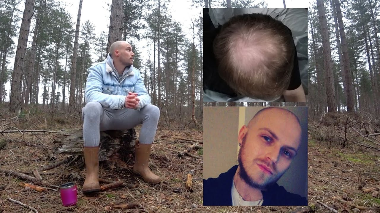 Your Lowest Point With Balding Is The First Step In Moving Past It For ...