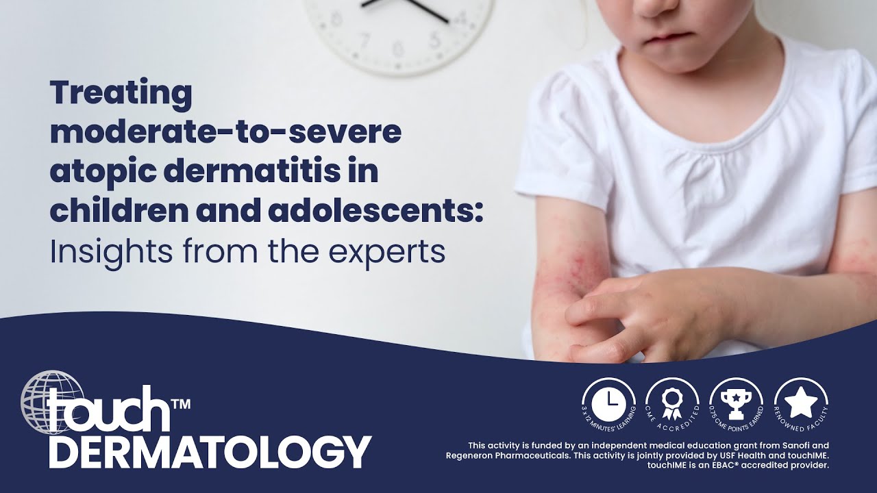 Treating moderate-to-severe atopic dermatitis in children and ...