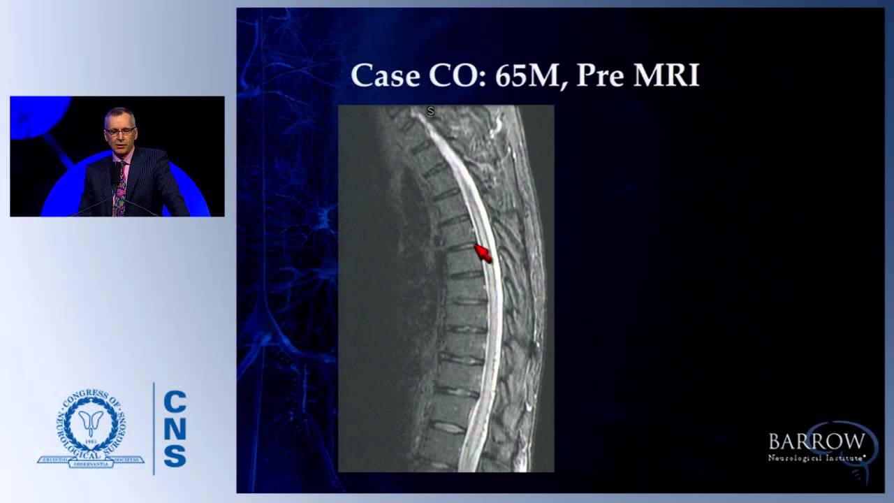 Spinal Dural Arteriovenous Fistulas: How, When and Why - YouTube