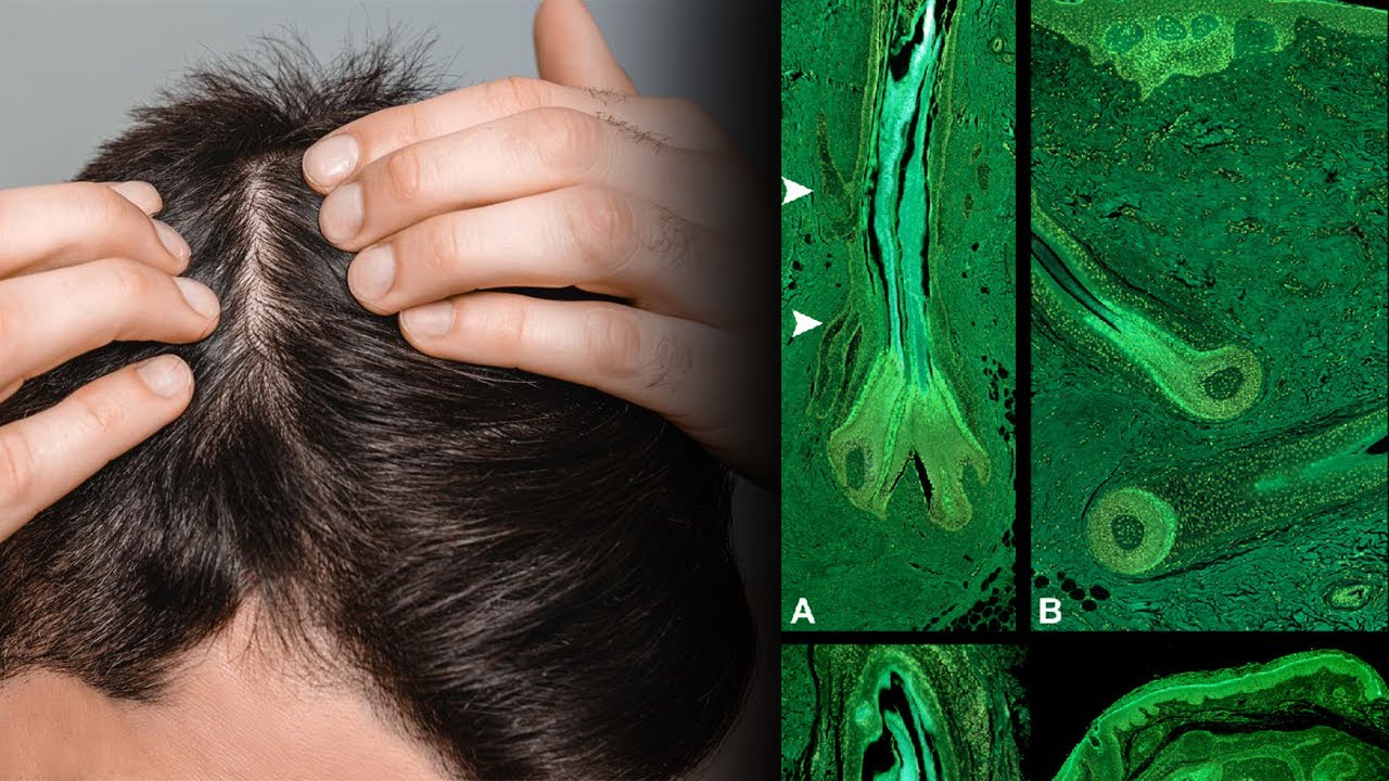 Dutasteride's Impact on Tissue DHT Levels - YouTube