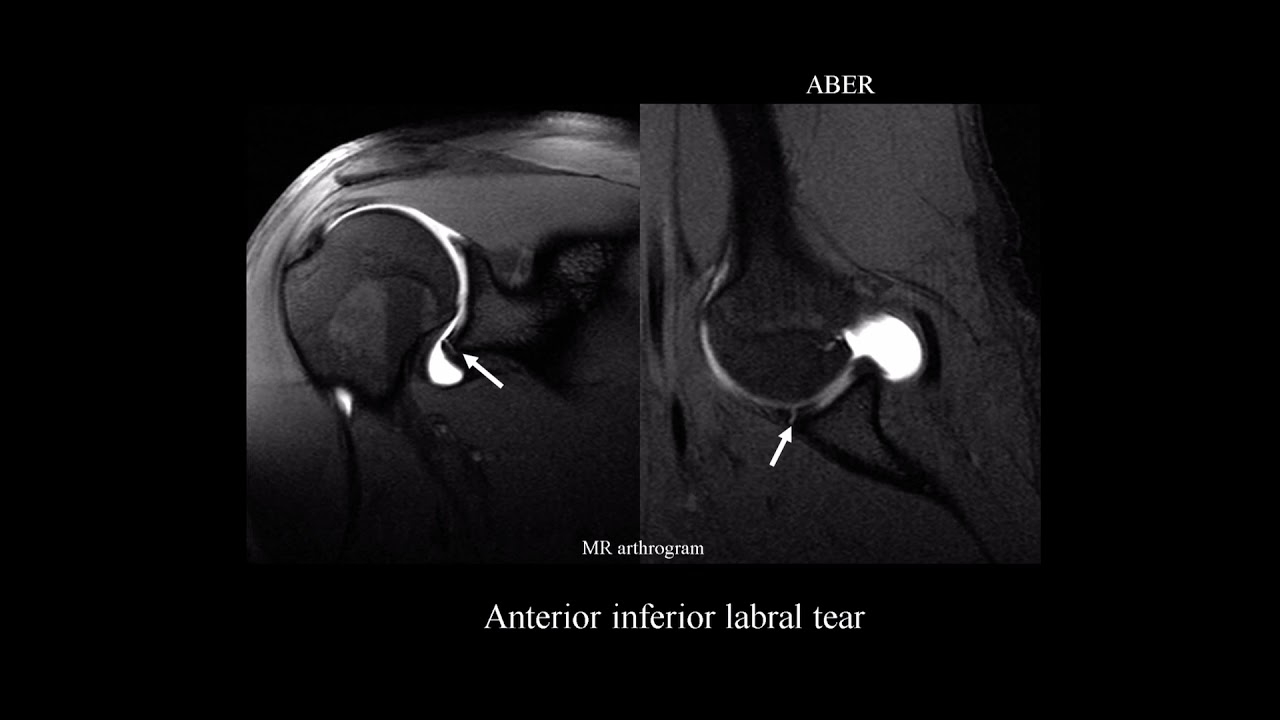 MRI shoulder labrum pathology - YouTube
