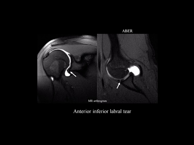Labrum Tear Mri