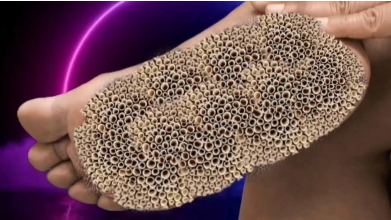 ASMR Animation Treatment Infected 🚑 Removing Cytes larvae and worms ...