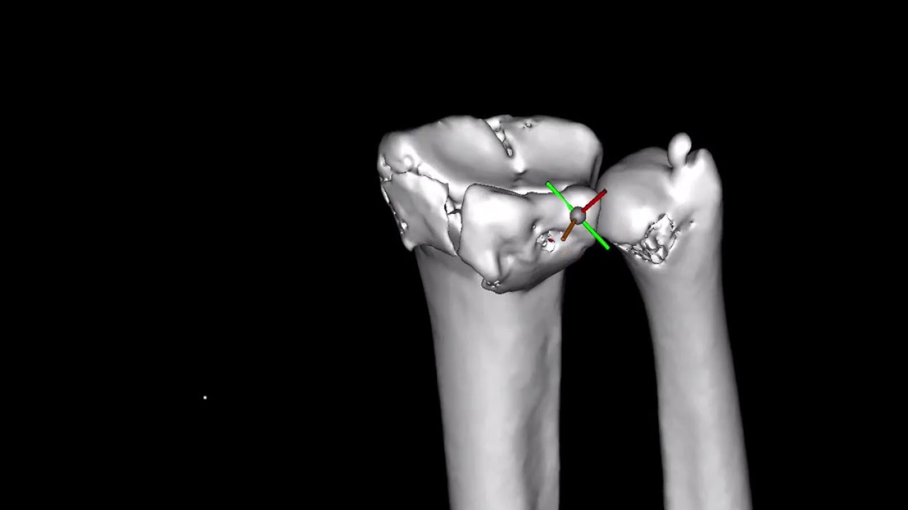 Distal Radius Fracture 3D - YouTube