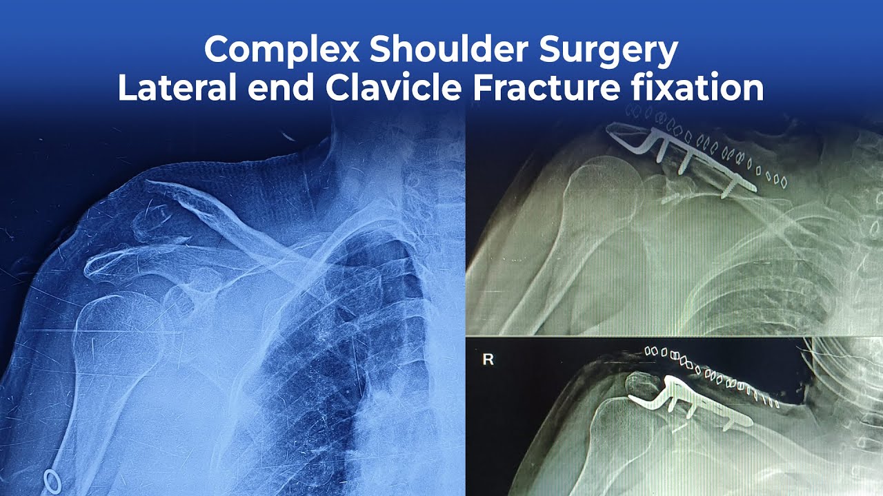 Complex shoulder surgery ~ lateral end clavicle Fracture fixation - YouTube
