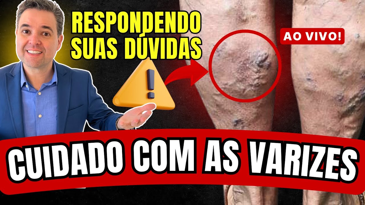 VARIZES NAS PERNAS CAUSAS E TRATAMENTOS | DR ALEX DORNELLES - YouTube