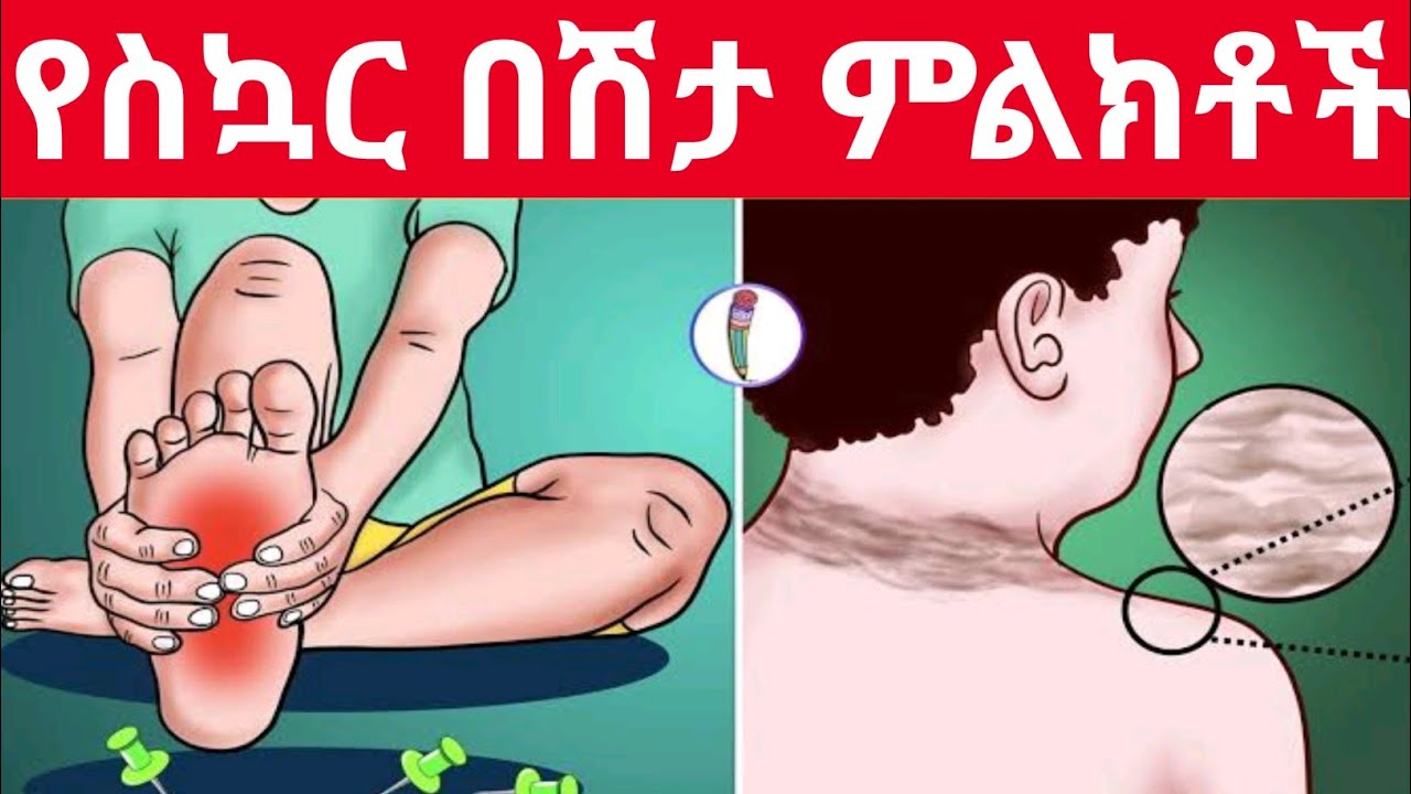 የስኳር በሽታ የመጀመሪያ አደገኛ 10 ምልክቶች Youtube