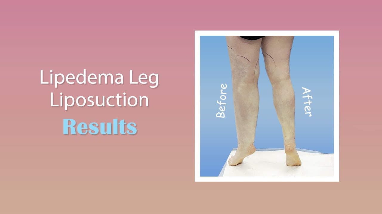 Lipedema Leg Liposuction Surgery | Immediate Results | Expert Dr ...