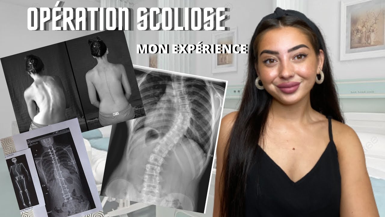 OPÉRATION SCOLIOSE | MON PARCOURS 🩻👨‍⚕️ - YouTube