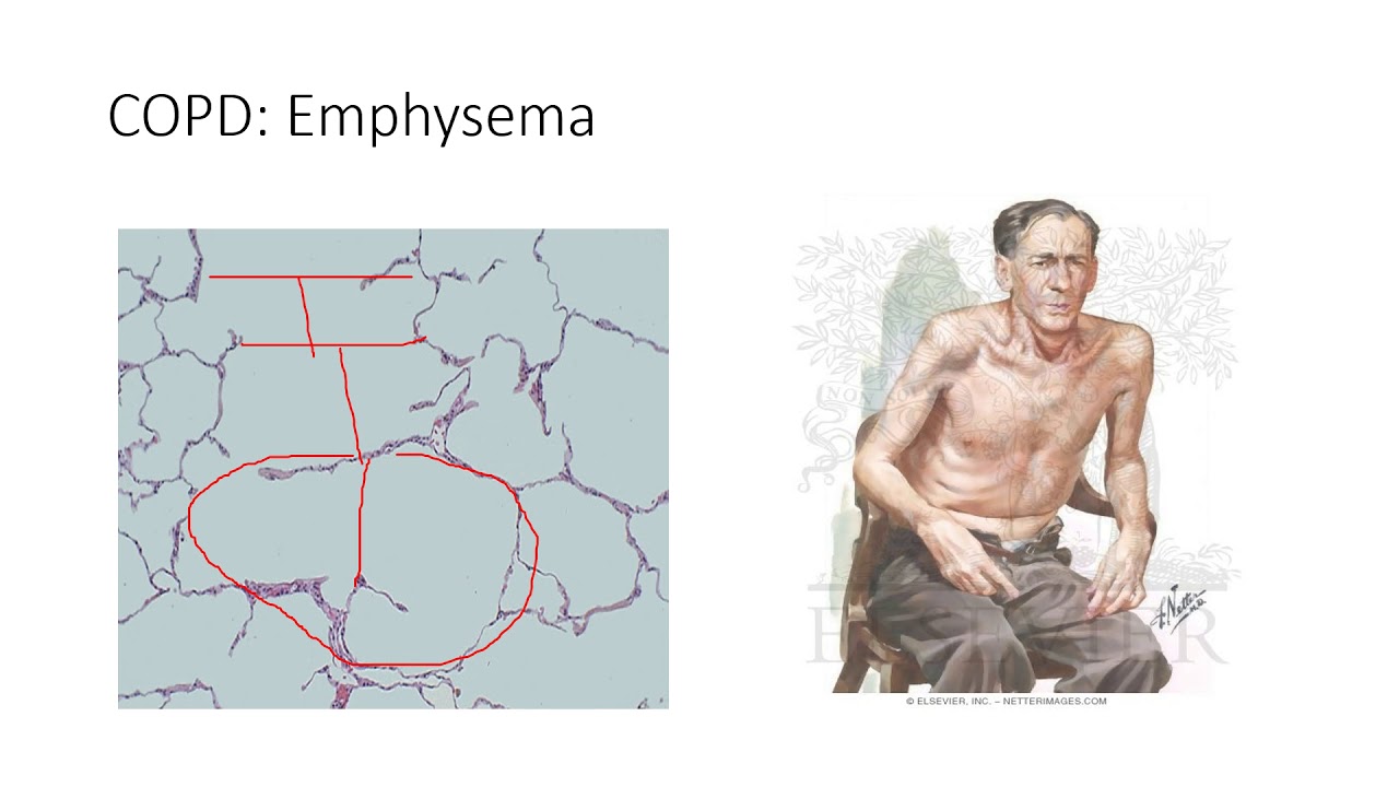 Chronic Pulmonary Pathophysiology 2: COPD Pathology - YouTube