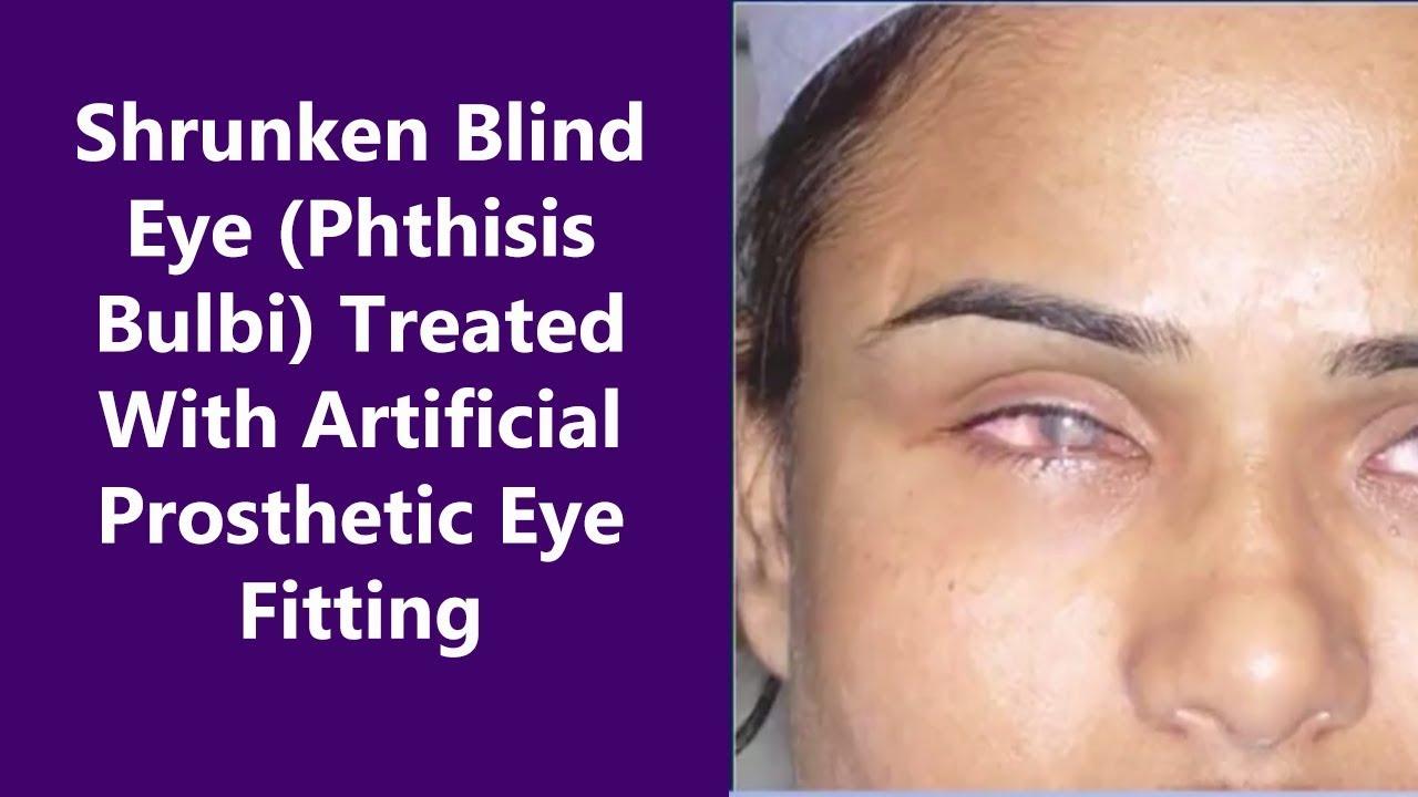 Enucleation / Evisceration Surgery Performed Followed By Prosthetic Eye ...