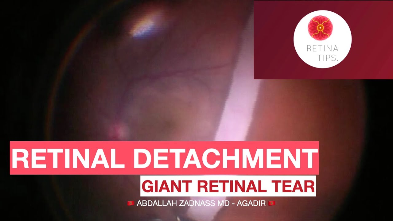 Repair of a retinal detachment associated with Giant retinal tear - YouTube