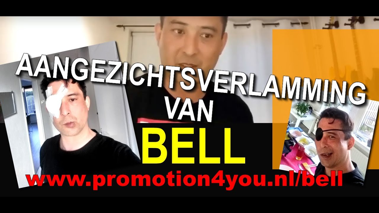 AANGEZICHTSVERLAMMING VAN BELL - BELL'S PALSY - BELLSE PARESE ...