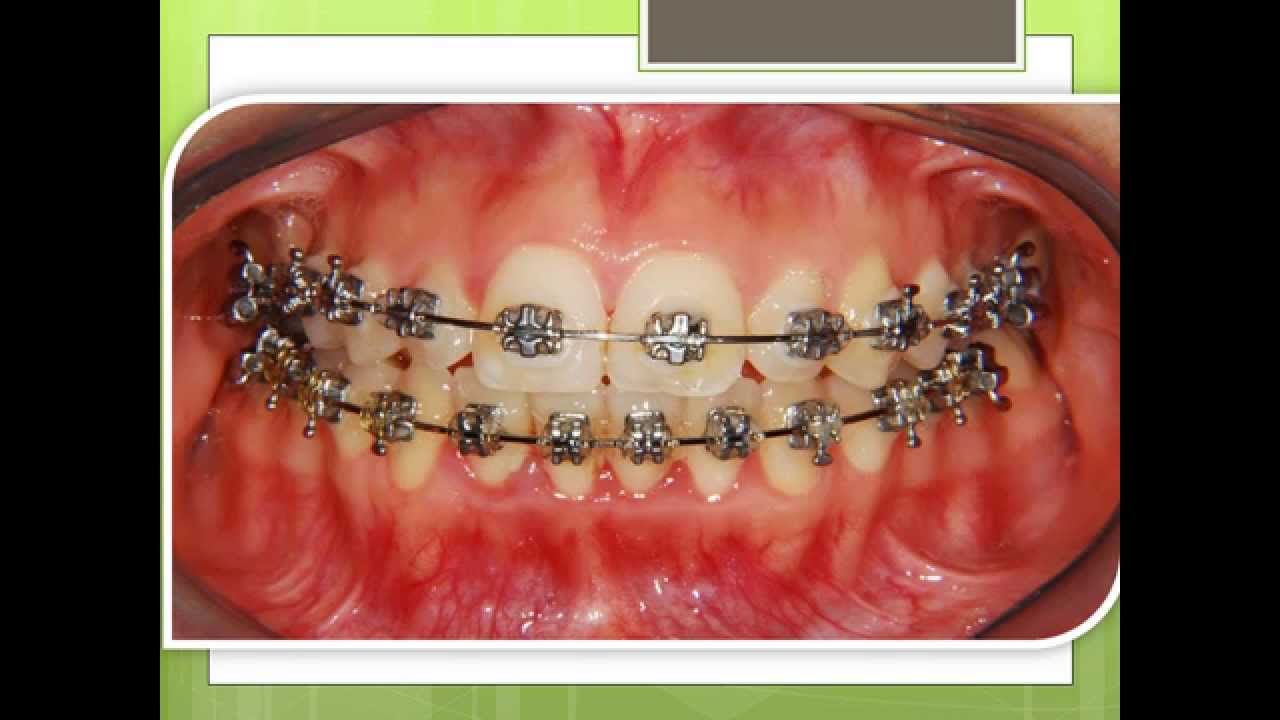 Low Friction Braces: Orthodontist - YouTube