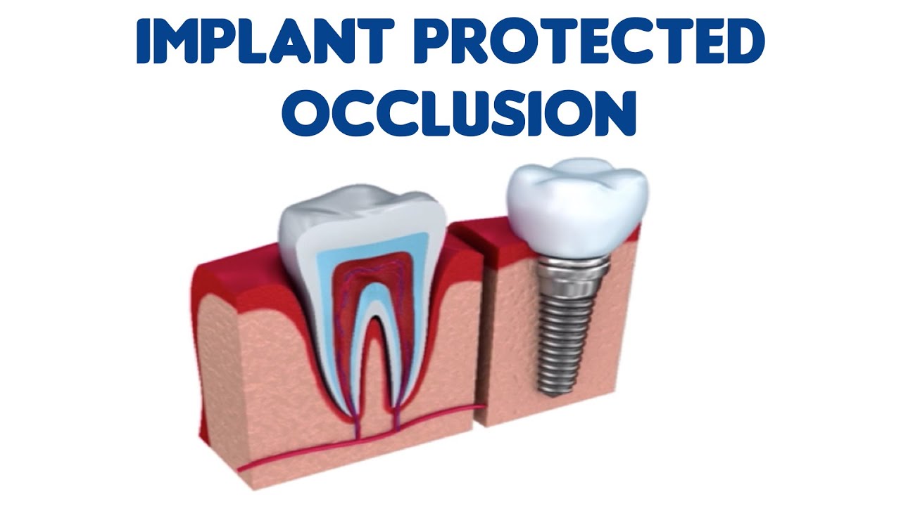 Implant protected occlusion - YouTube