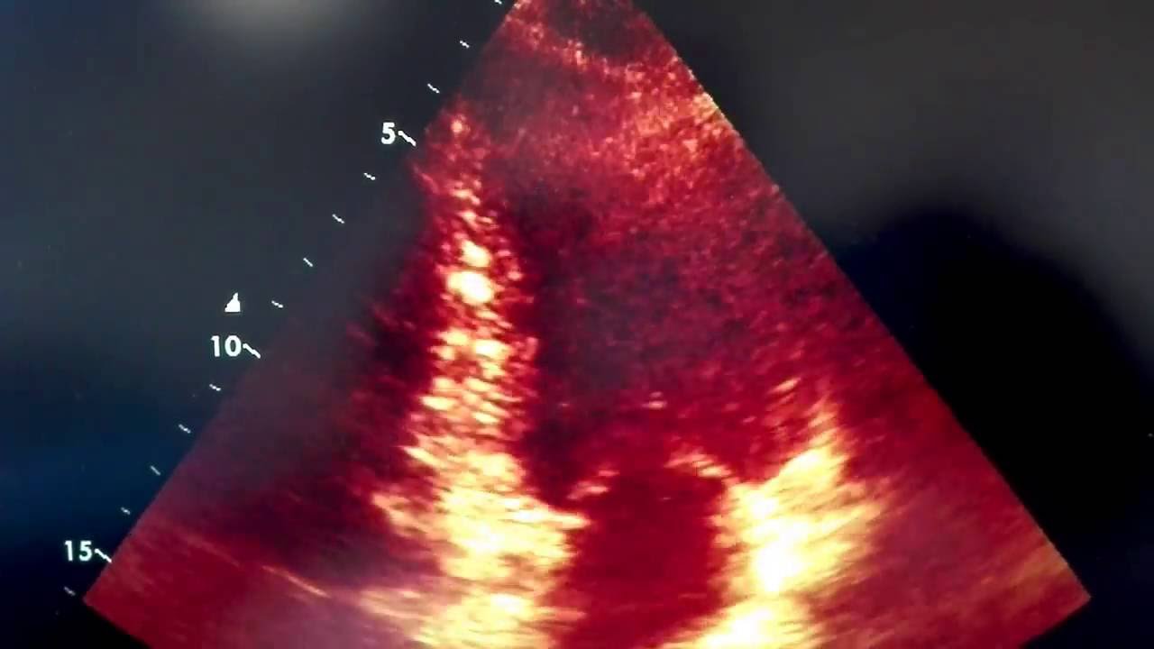 Myocardial crypts or non diagnostic volume of non compaction myocardium ...