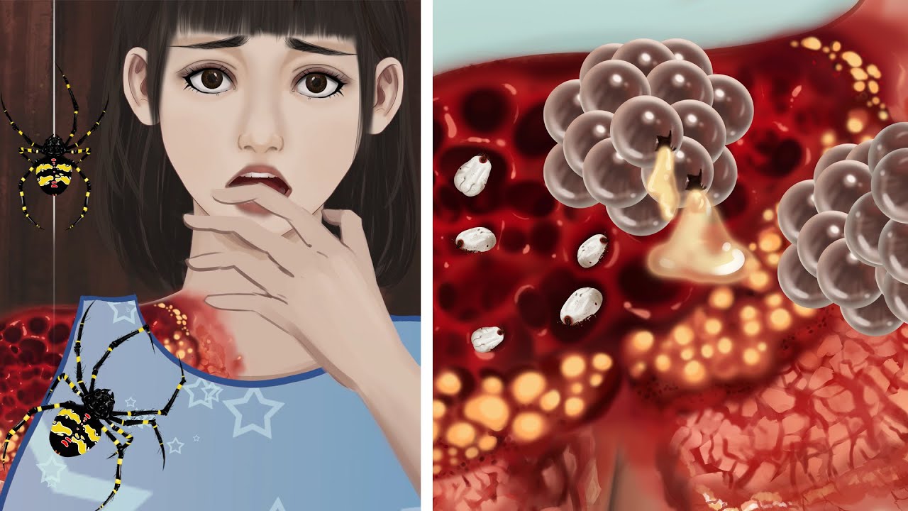 ASMR｜Removing Ticks from Farmer's Woman's Shoulder｜Trypophobia cautious ...