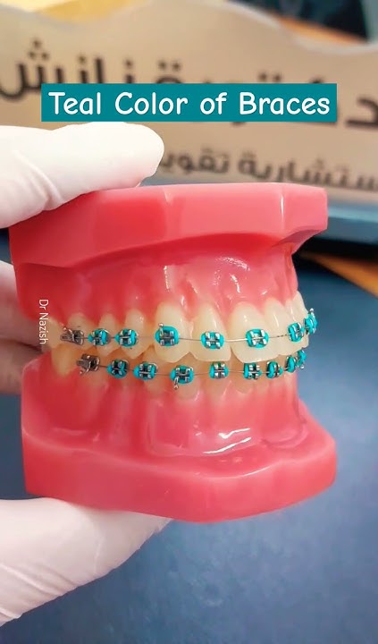 Teal Color Of Bracesdr Nazish Youtube