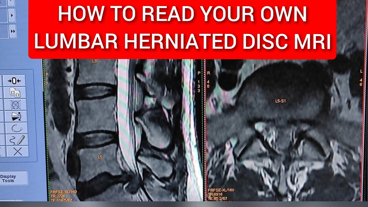 Lumbar Herniated Disc MRI - YouTube