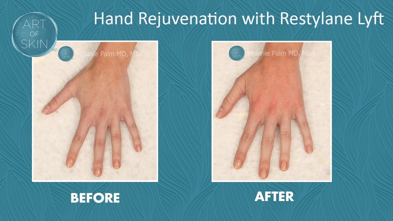 Hand Rejuvenation with Restylane Lyft - YouTube
