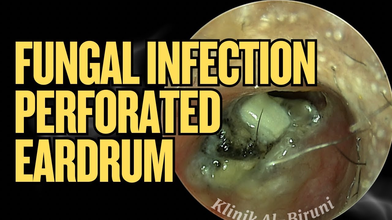 Fungal Infection Perforated Eardrum - YouTube