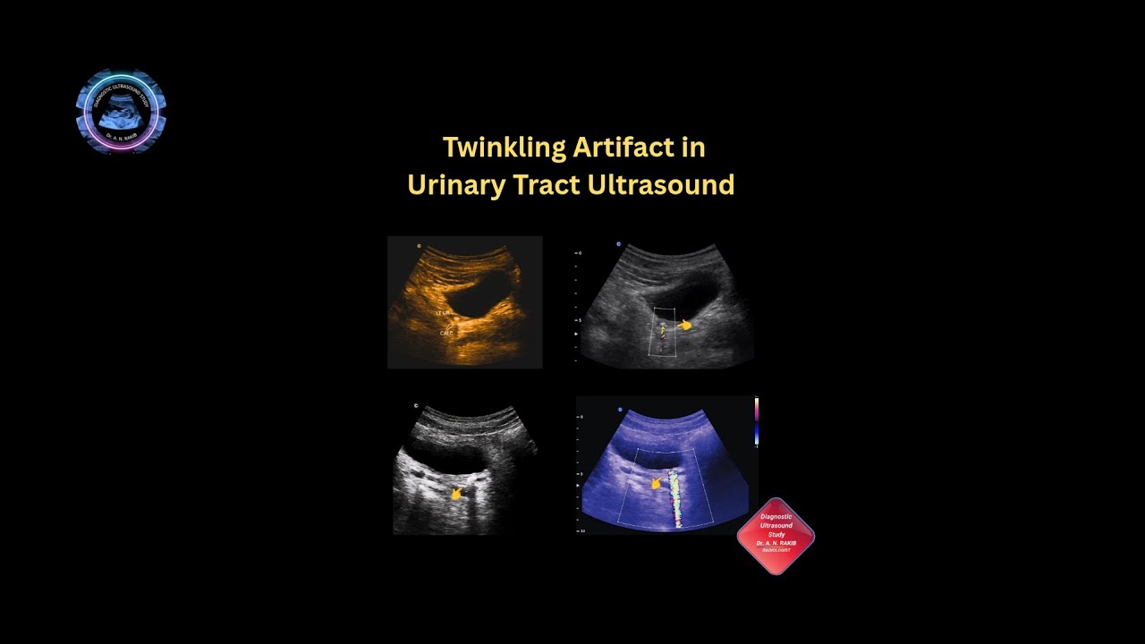 Twinkle Artifact in Urinary Tract Ultrasound | Valuable Sonographic ...