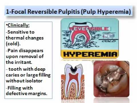 Pulp Diseases (Oral Pathology).wmv - YouTube
