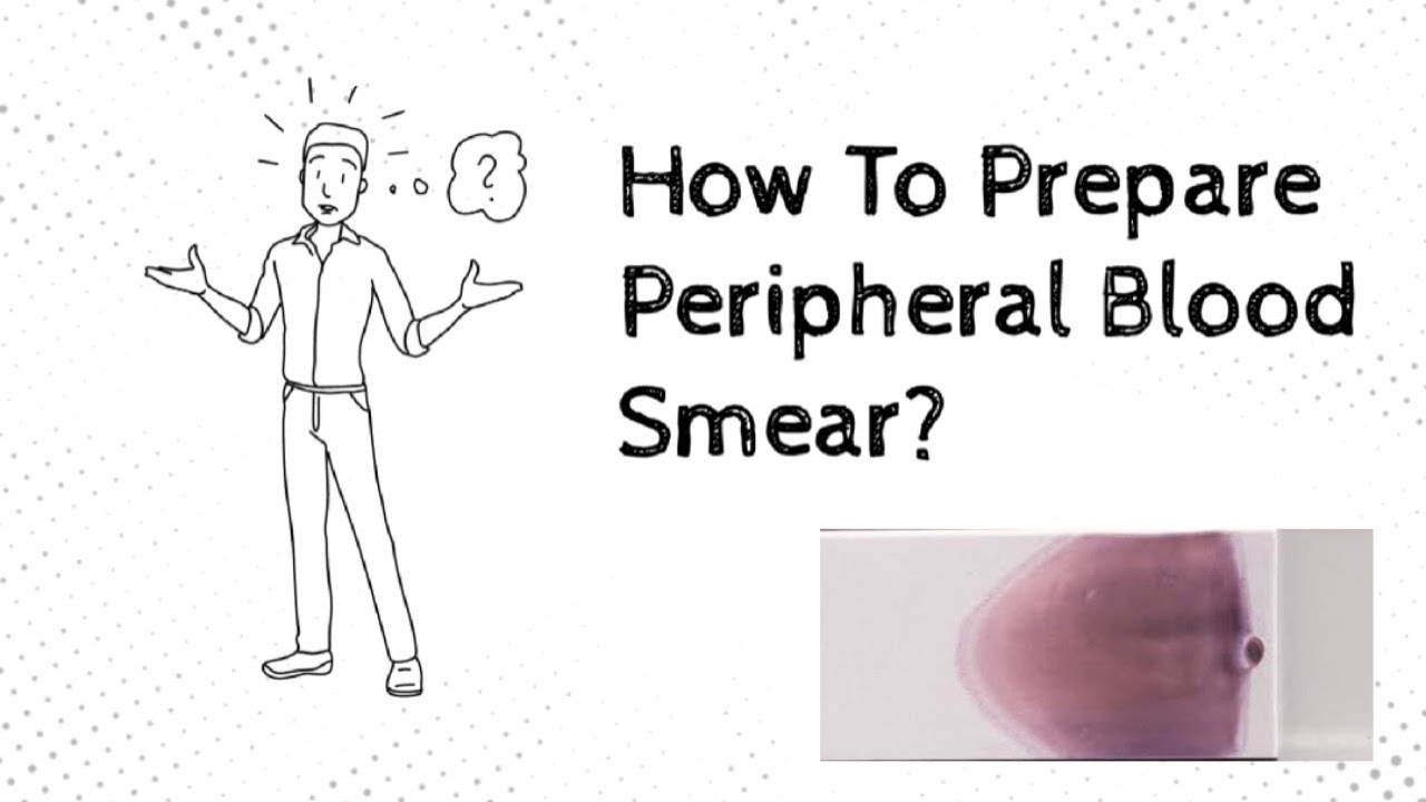 How to Prepare Peripheral Blood Smear🩸 ? | Method of Preparation ...