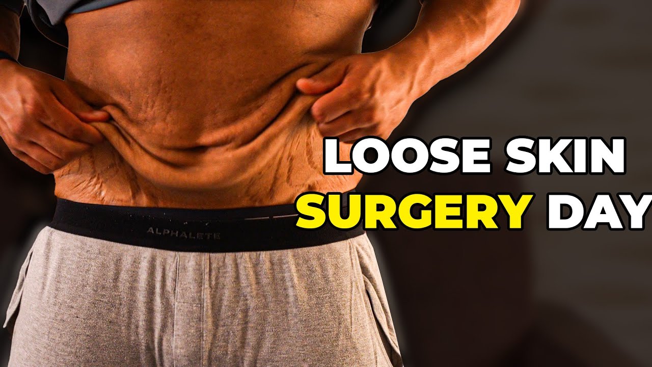 Today, I remove my loose Skin (Surgery Day) - YouTube