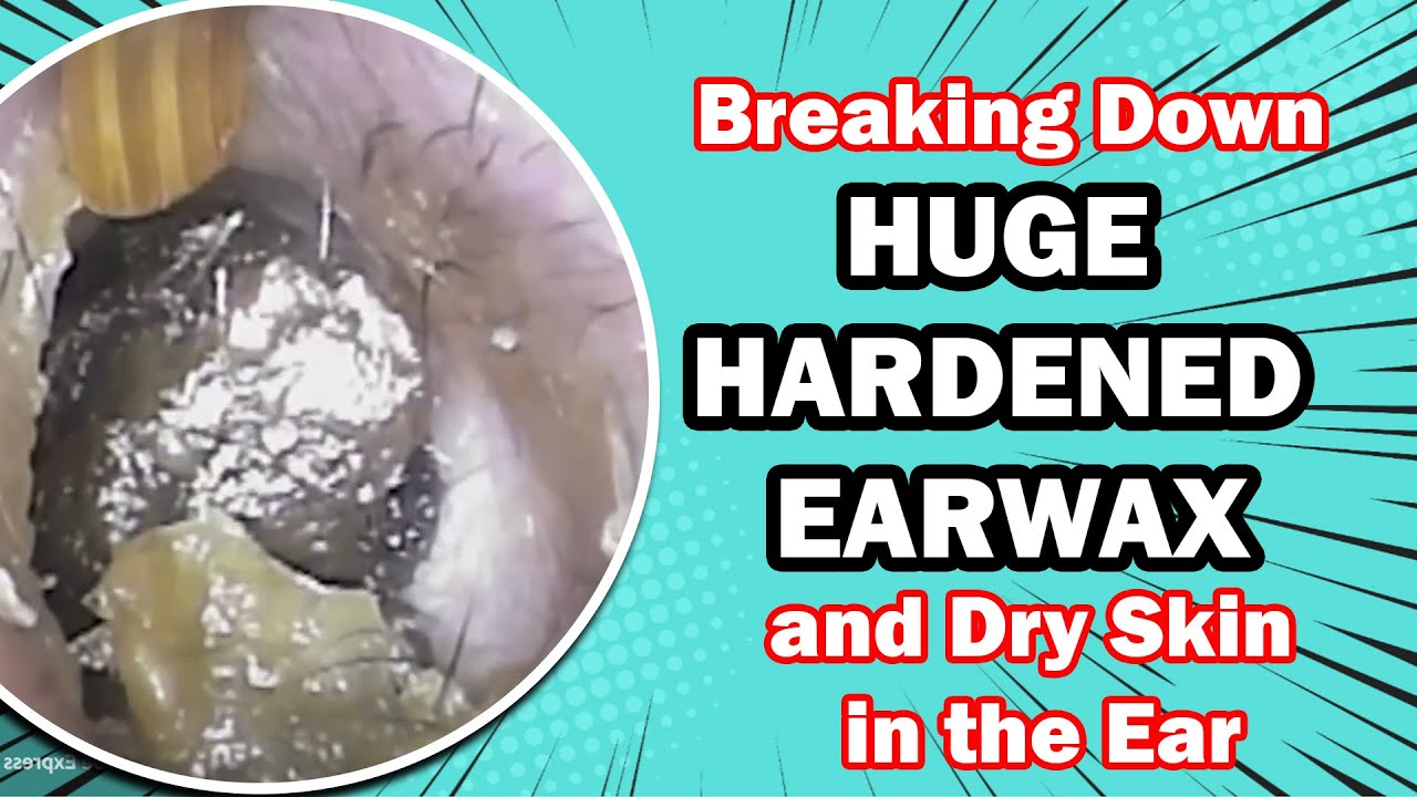 Breaking Down | Huge Hardened earwax and dry skin in the ear - earwax ...