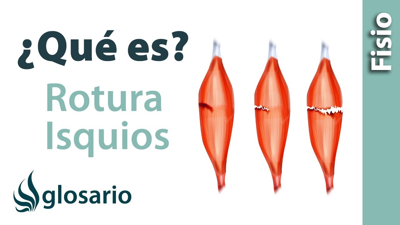 ROTURA MUSCULAR EN LOS ISQUIOTIBIALES | ¿Qué es? - YouTube
