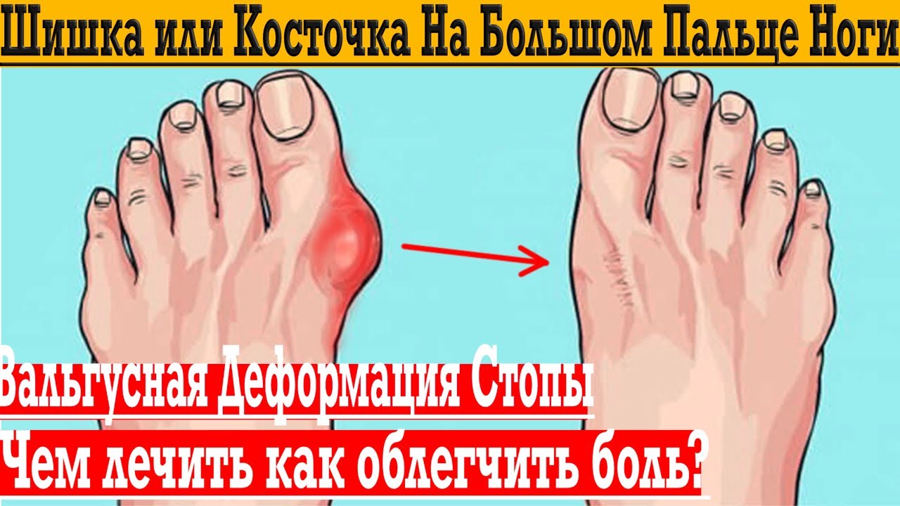 Шишка или косточка на большом пальце на ноги Вальгусная деформация