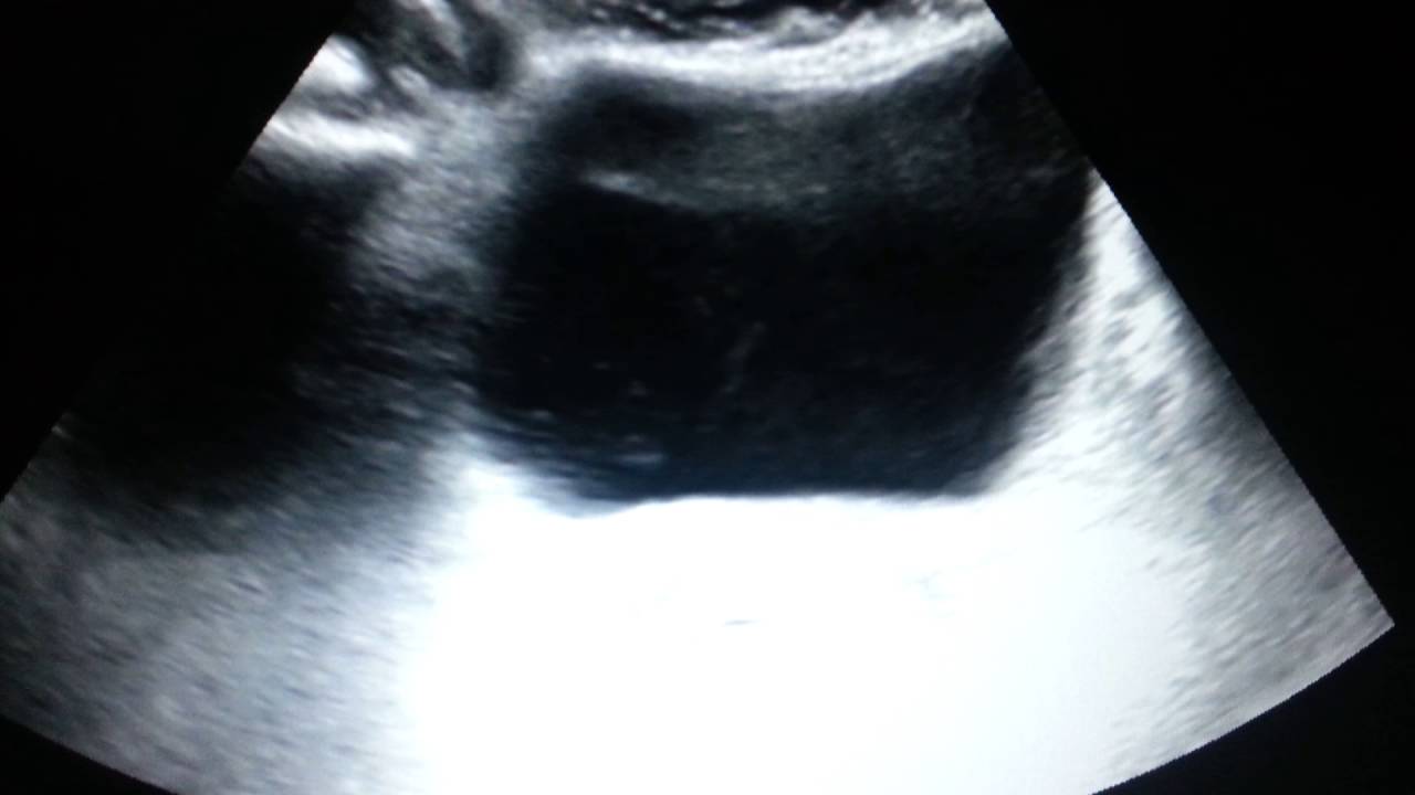 Ureteric jet - YouTube