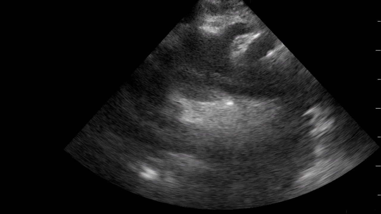 Ultrasound scan of Thoracic aorta shows floating flap inside the aortic ...