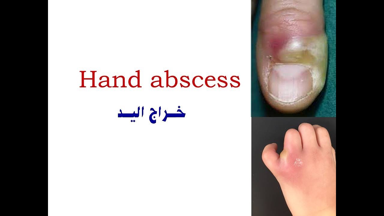 Hand abscess فيديو 186 - YouTube