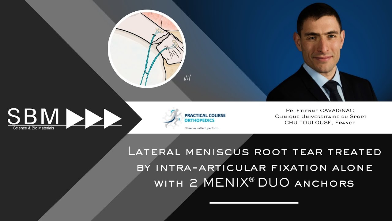 Pr. Cavaignac Surgical Technique: Lateral Meniscus Root Tear Treated By ...