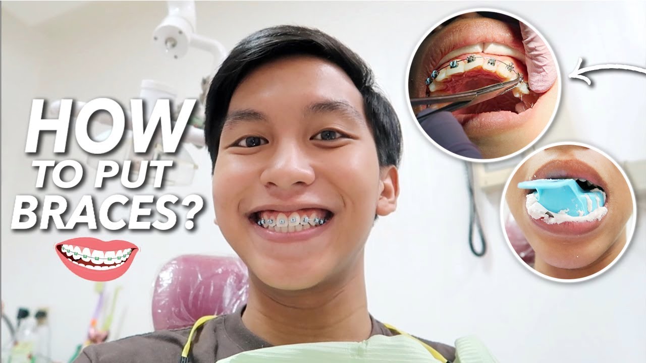 I Got Braces! + Step-by-Step Procedure (Masakit ba?) - YouTube