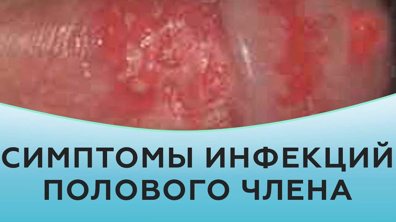 Симптомы инфекций полового члена Youtube