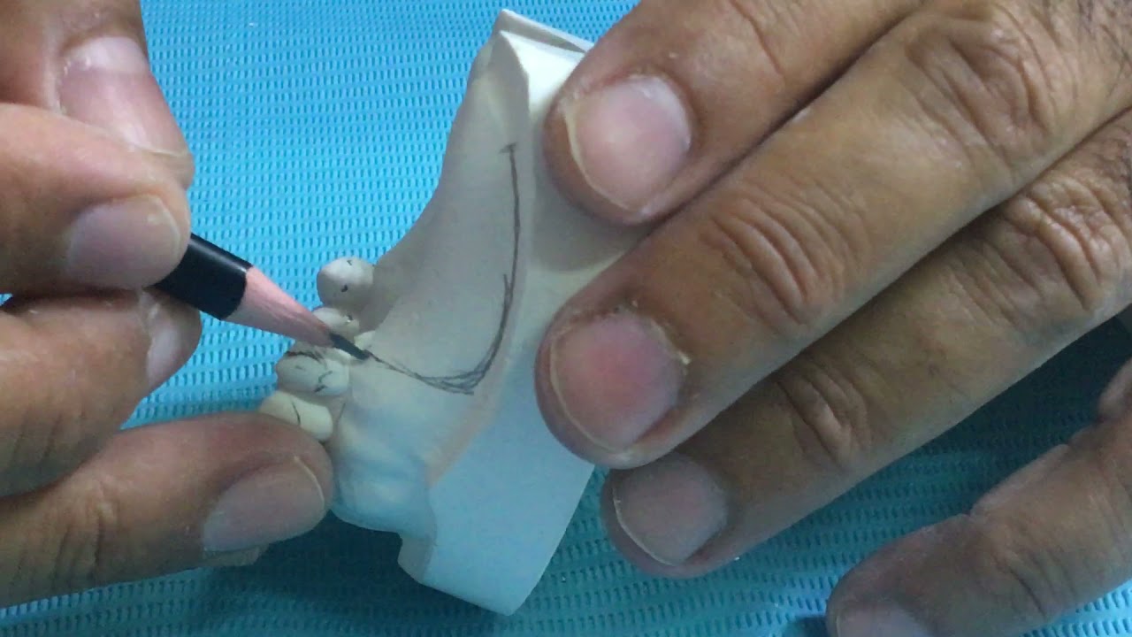 Max Class I acrylic RPD designing on cast - YouTube